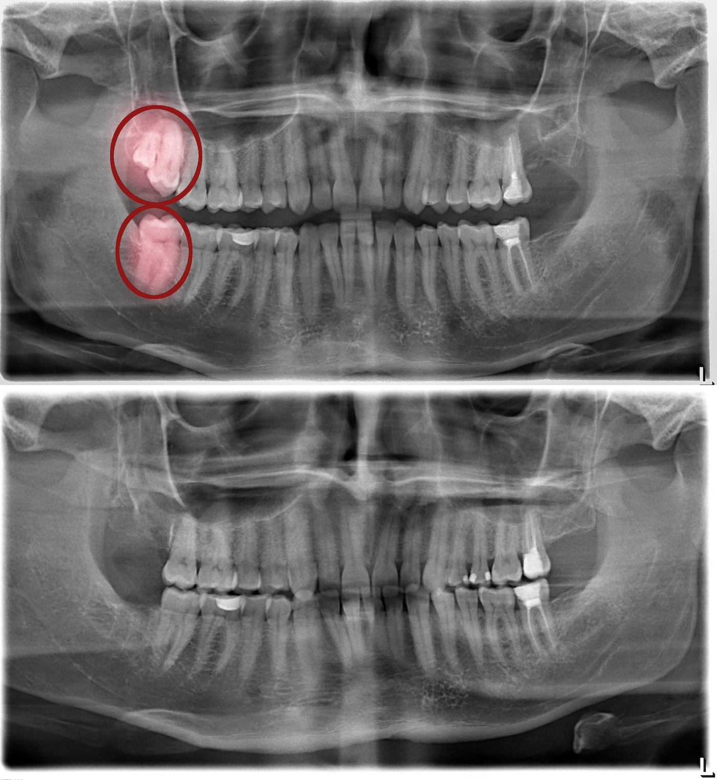 Wisdom Teeth Removal | Bullhead City Dentistry
