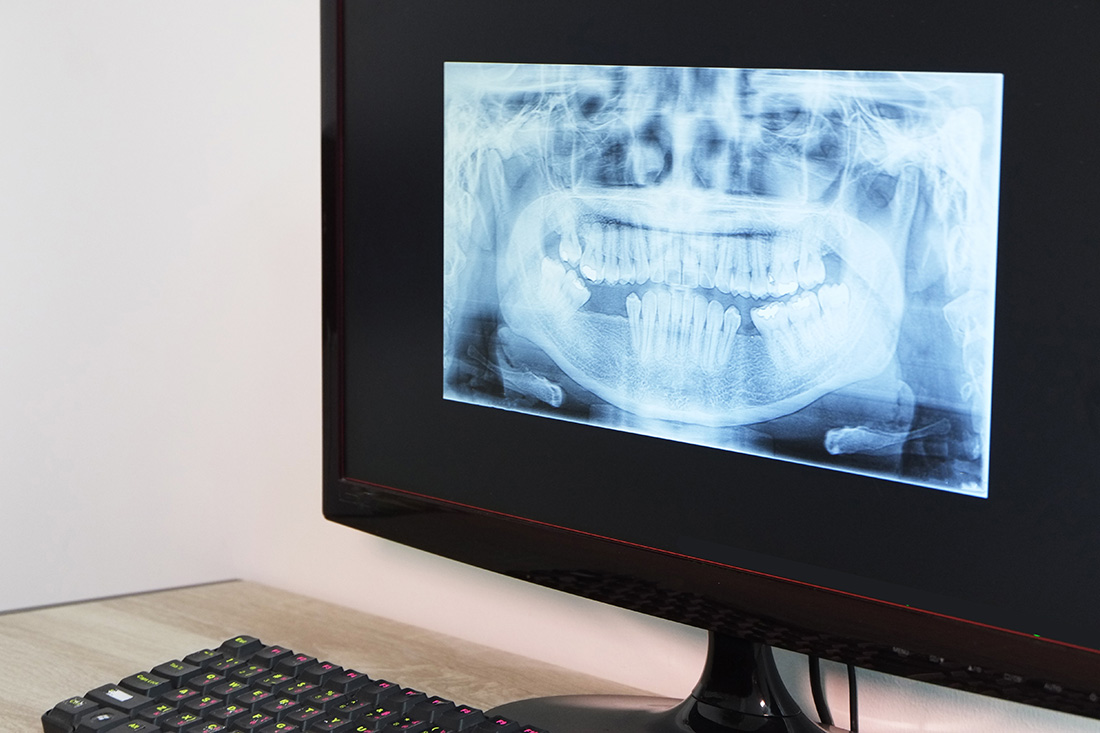 Digital X-Rays in Baton Rouge | Stevens Dental | Stevens Dental