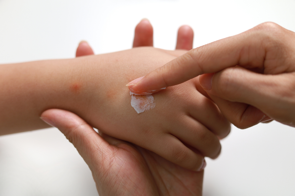 Bug Bites and Stings: Types, Treatment, and Prevention - Blueberry ...