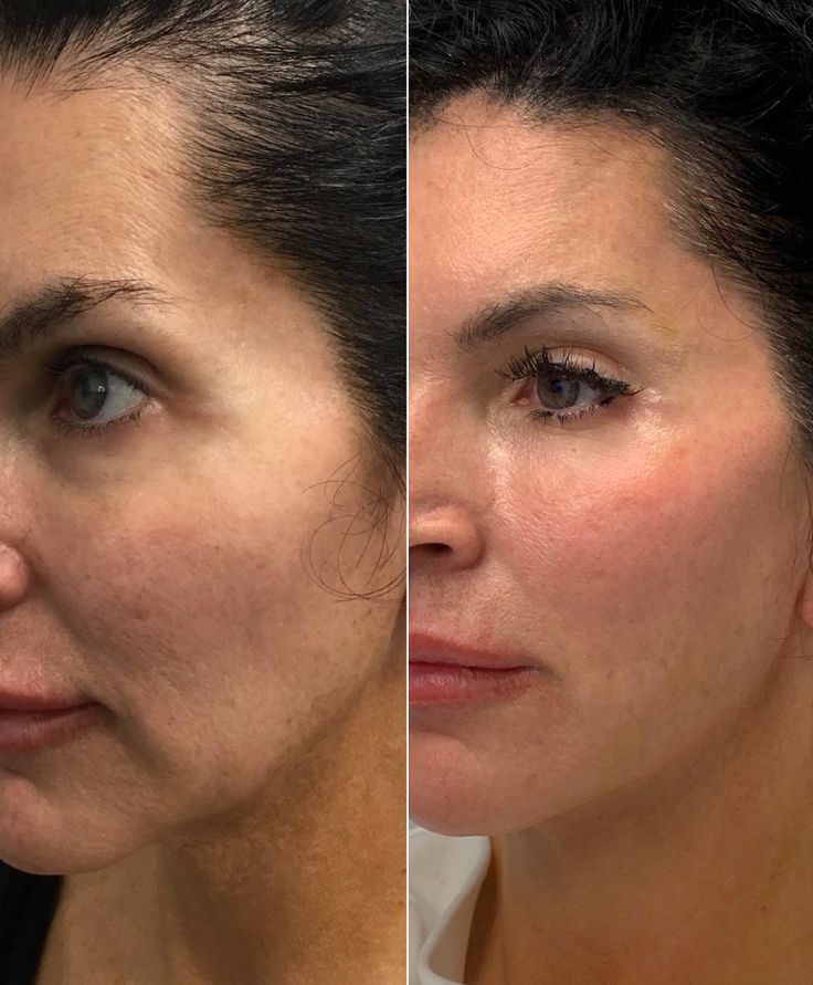 Botox Nose Slimming Services | Clinique Main d'Or