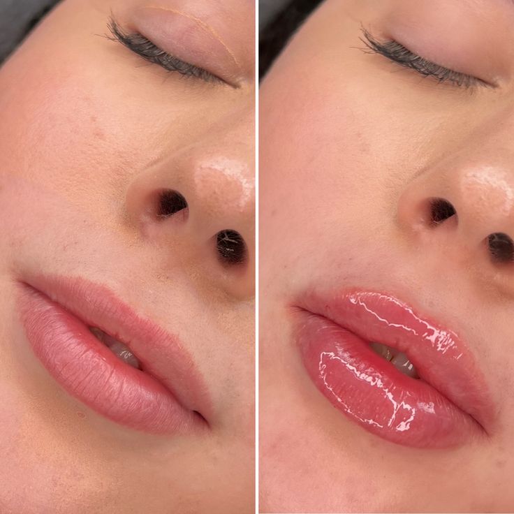 Botox Lip Flip for Natural-Looking Fuller Lips | Clinique Main d'Or