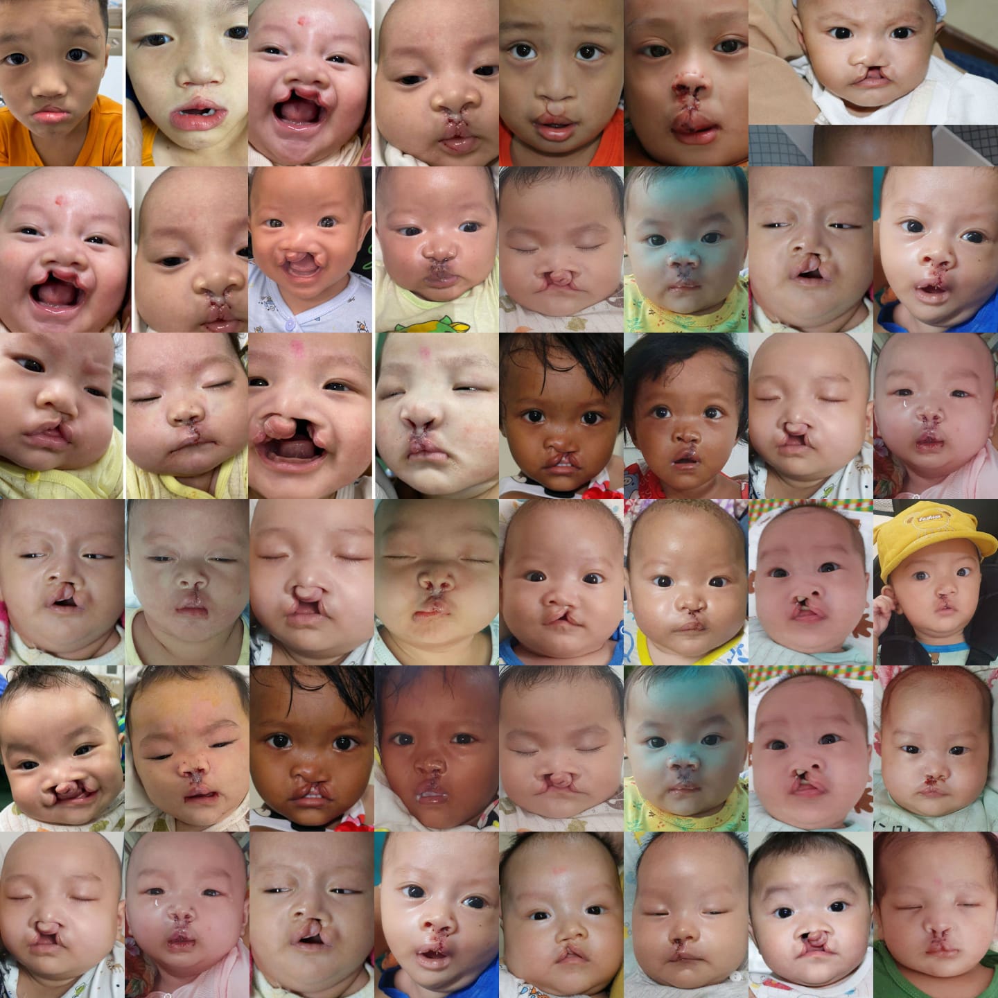 Changing Families: How Operation International Repaired Cleft Lips for ...