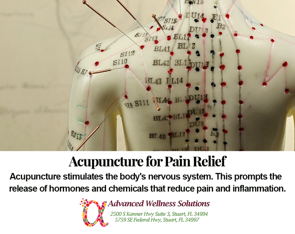 How Acupuncture Can Improve Your Health Joyful