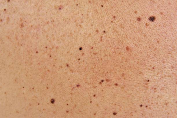 Laser Freckles Removal: Cost In Singapore