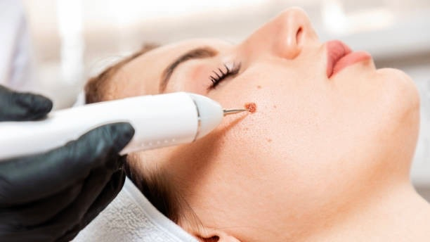 Hyperpigmentation After Laser & Other Common Side Effects