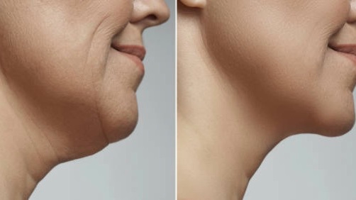 Thermalift For Sagging Jowls: How Does it work?