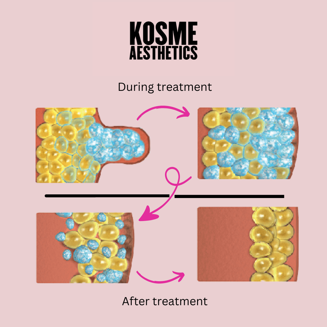 Top 5 Professional Fat Freezing Devices for a Sculpted Body