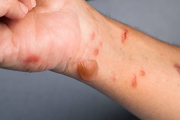 Cryotherapy Blister Healing: What to Expect