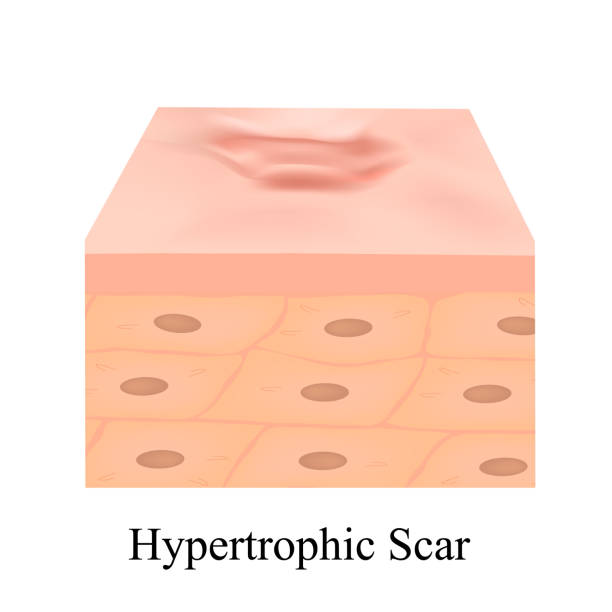 Acne Scars Types Guide