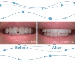 Partial Dentures in Merrillville, IN - Richter Dental