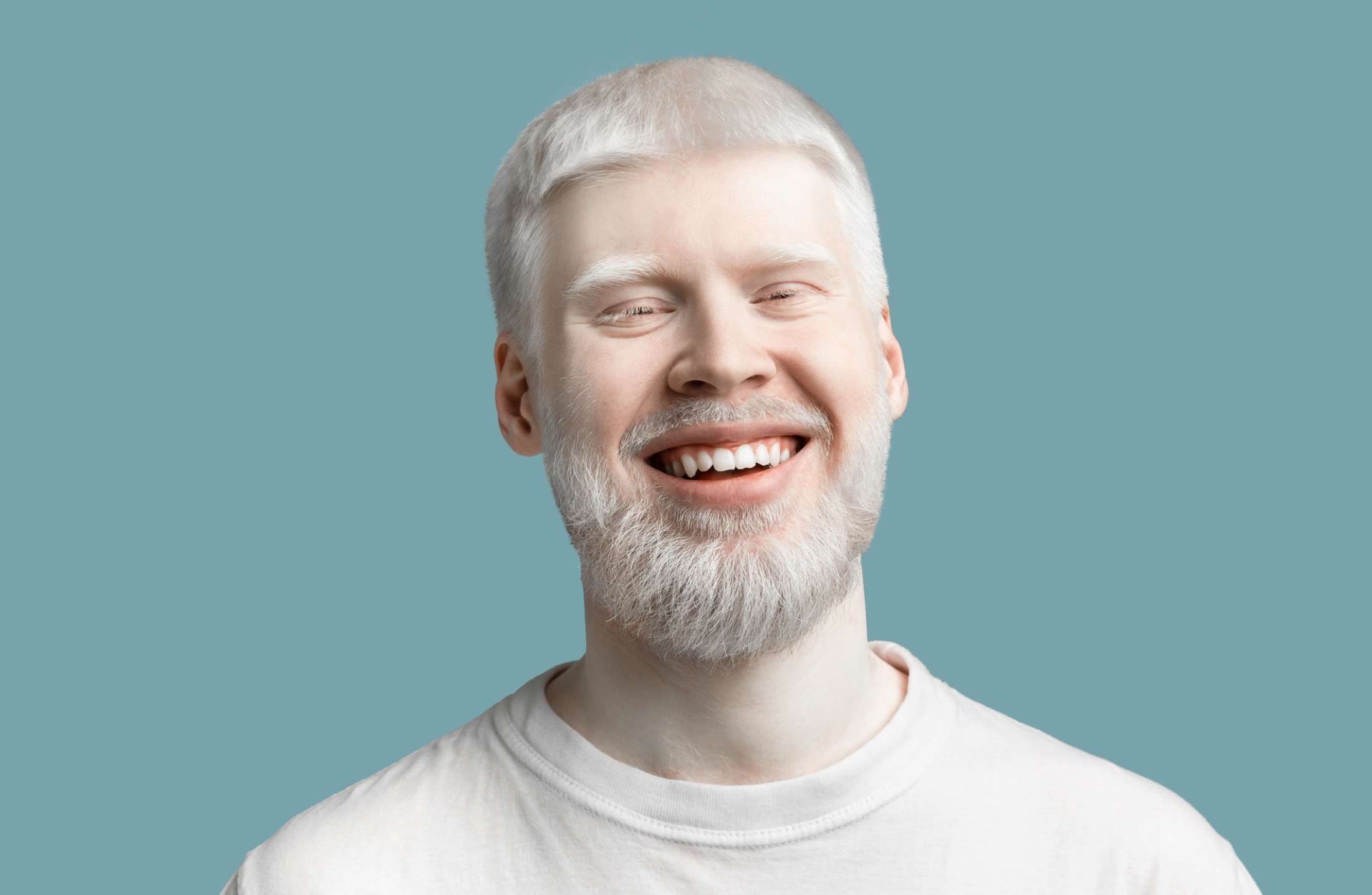 Albinismo: tire todas as suas dúvidas sobre o assunto