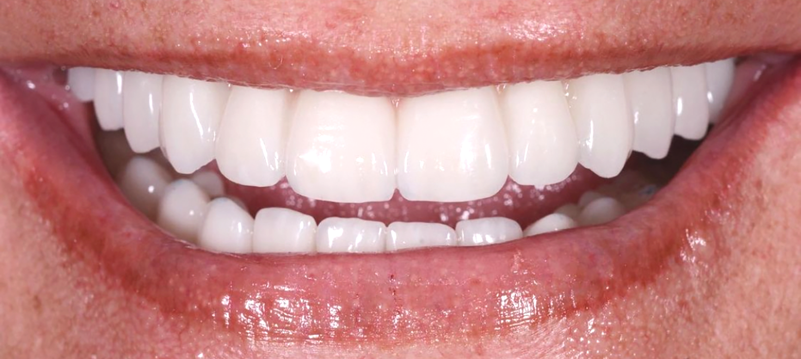 Dr. Yasin Aktas - All-on-4 Behandlung