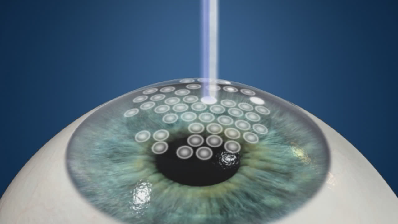 What is PRK Eye Surgery? | PRK vs LASIK: the Difference Between LASIK and PRK