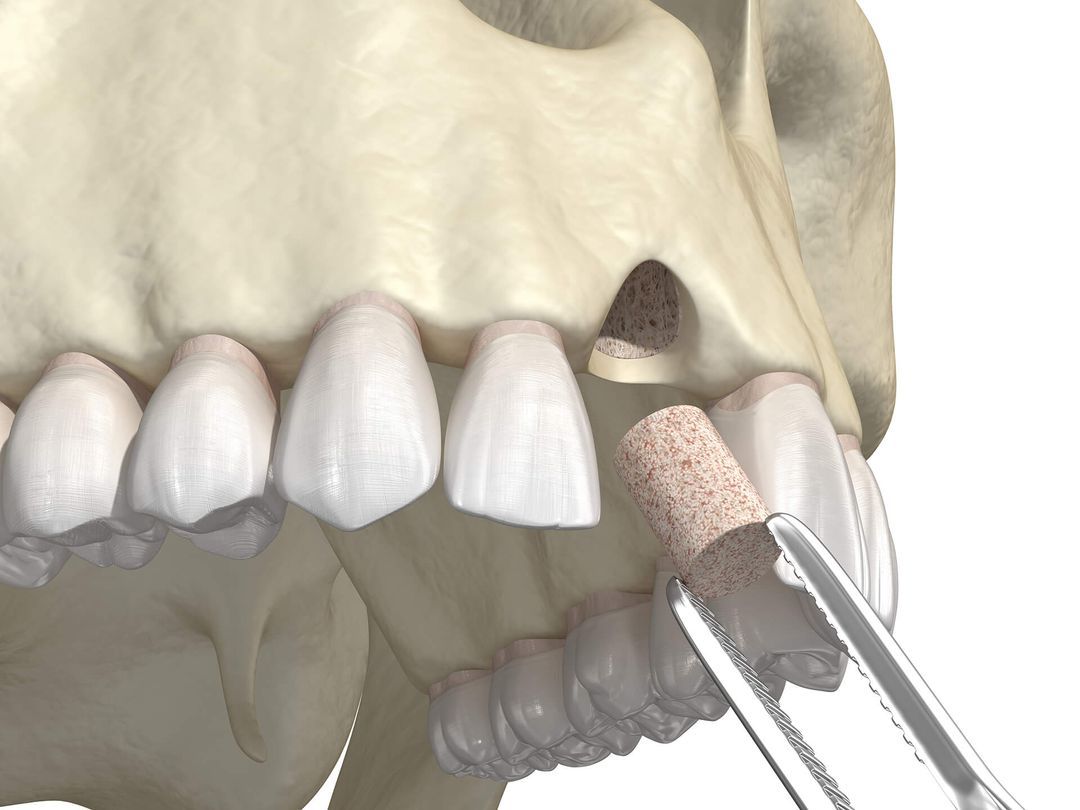 Bone Grafting in Chicago and Archer Heights - Smile Dental Center