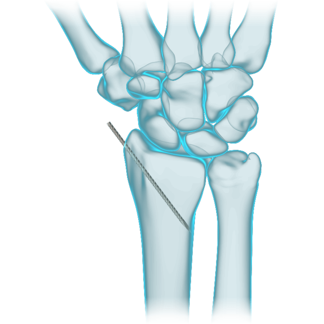 The Future of Personalized Musculoskeletal Reconstruction | restor3d