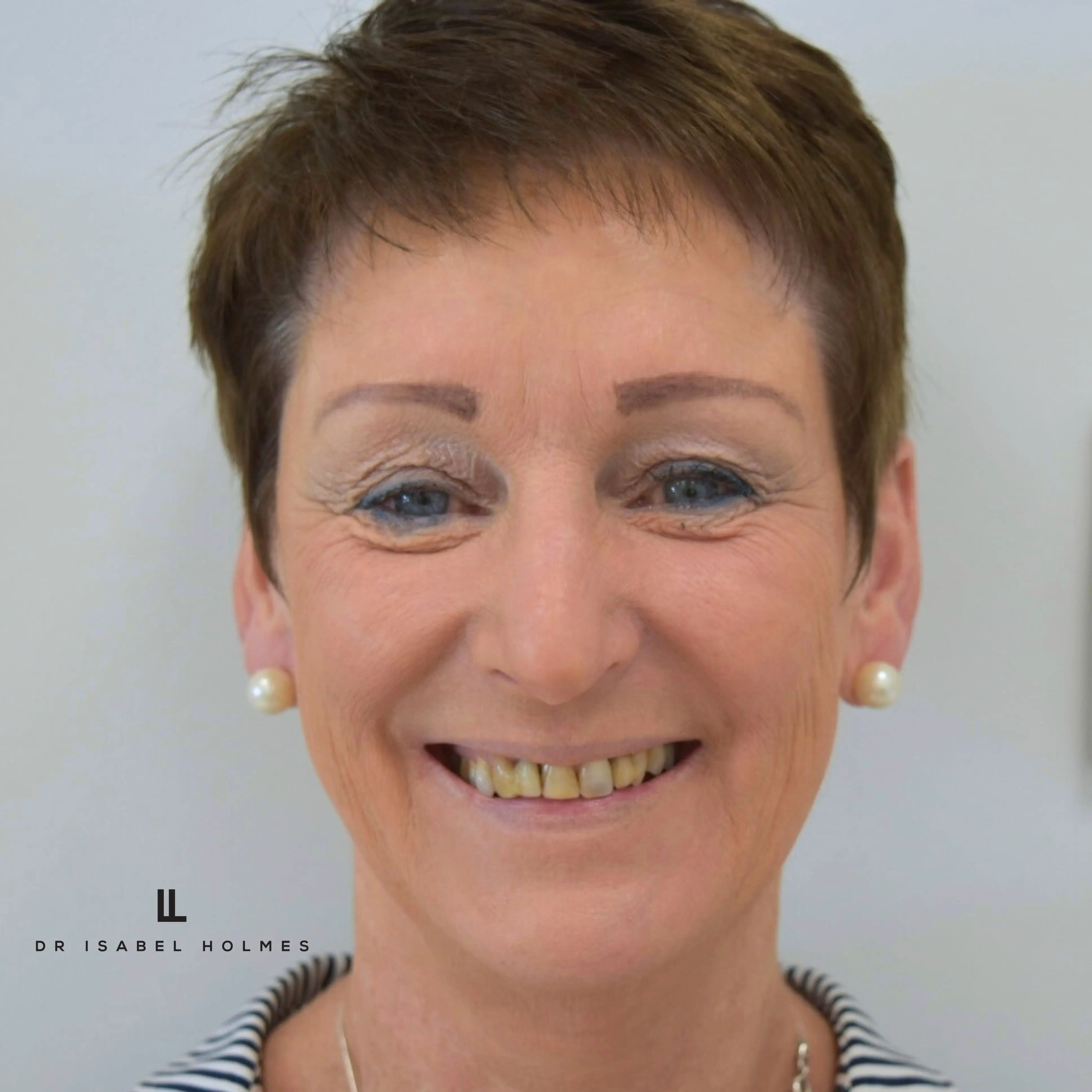 Dental crowns – converting damaged teeth into beautiful smiles