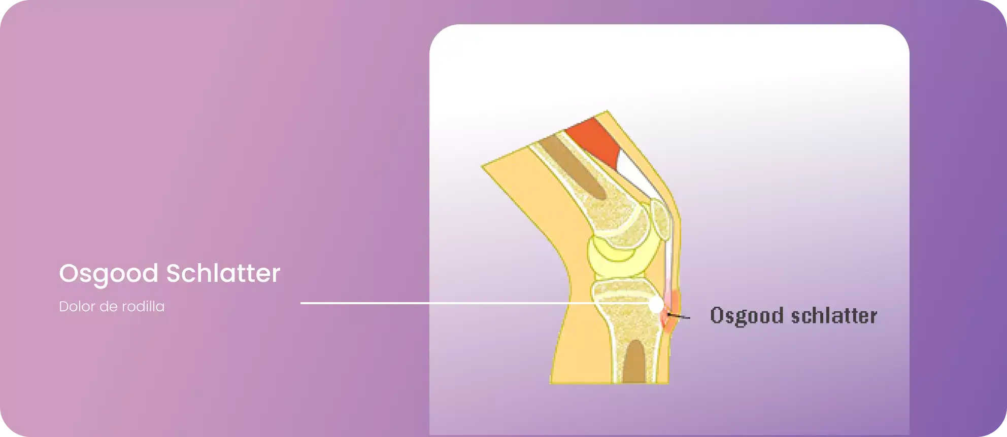 Osgood Schlatter