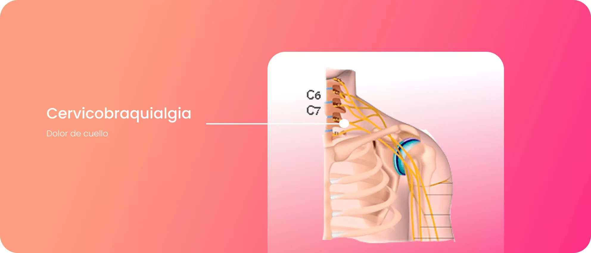 Cervicobraquialgia