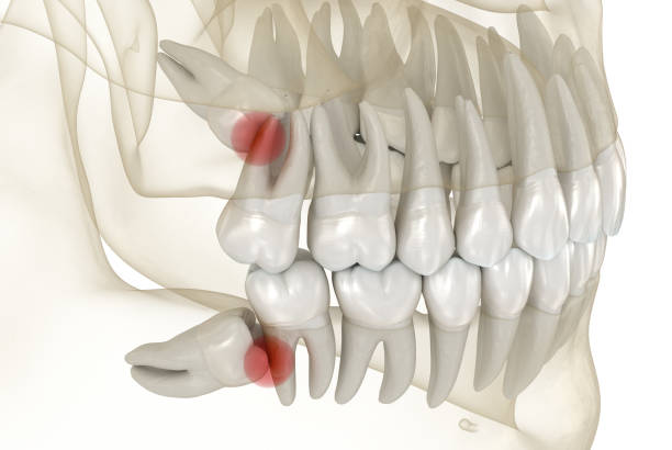 Wisdom Teeth Removal & Extraction Auckland | Auckland Family Dental