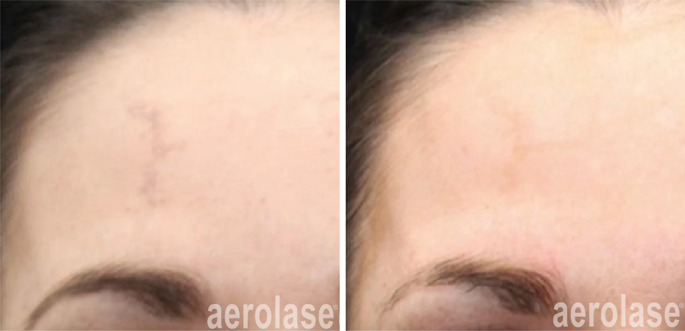 Aerolase NEO | Renual Medspa Myrtle Beach, SC