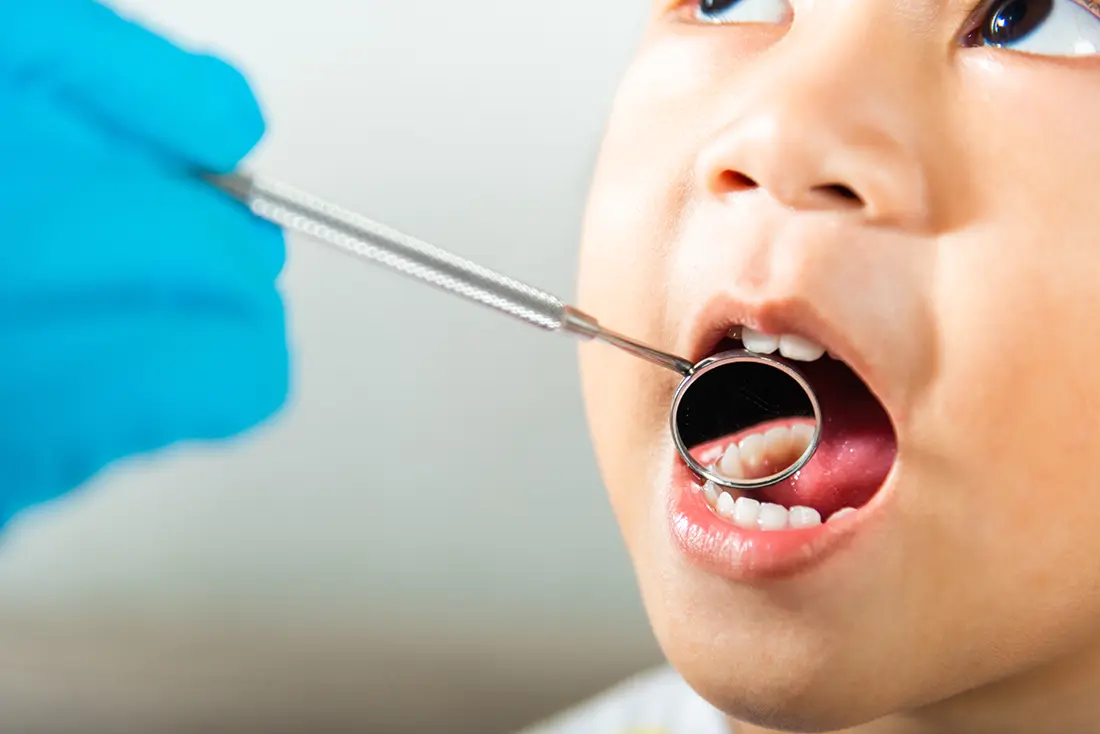 Pediatric Dental Fillings In Elk Grove & Folsom | The Spot for Smiles