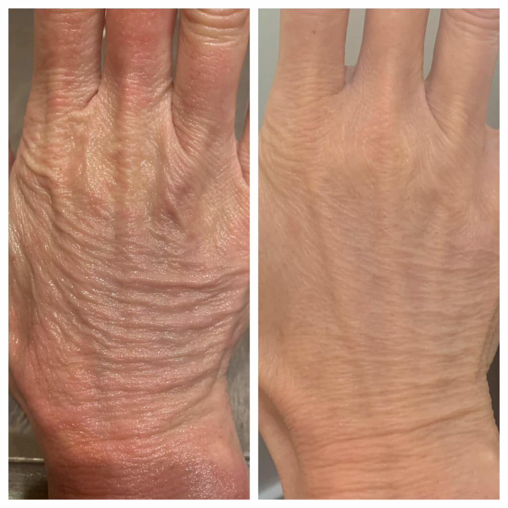 Hand Restoration, Lone Tree CO | The Firm Medspa