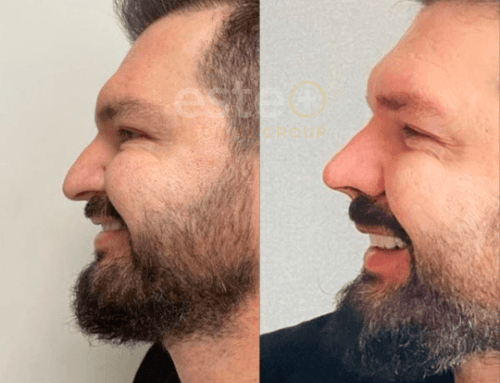 Nose Job Turkey | Rhinoplasty Turkey | Septoplasty Turkey - Este