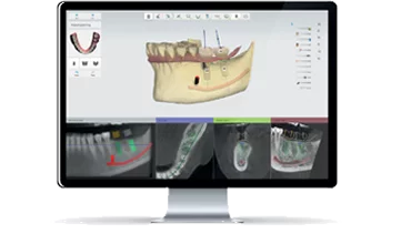 3Dcelo | Planification implantaire numérique et règles de placement d’implant