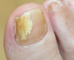 My Toenails Don't Look Good - Do I Have a Problem? | Hyperhealth