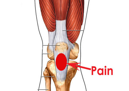 Presentation of Jumper's Knee (Patella Tendinopathy) | Hyperhealth