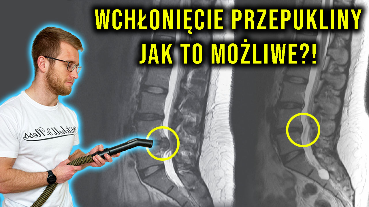 PRZEPUKLINA KRĘGOSŁUPA• MOŻE SIĘ COFNĄĆ?