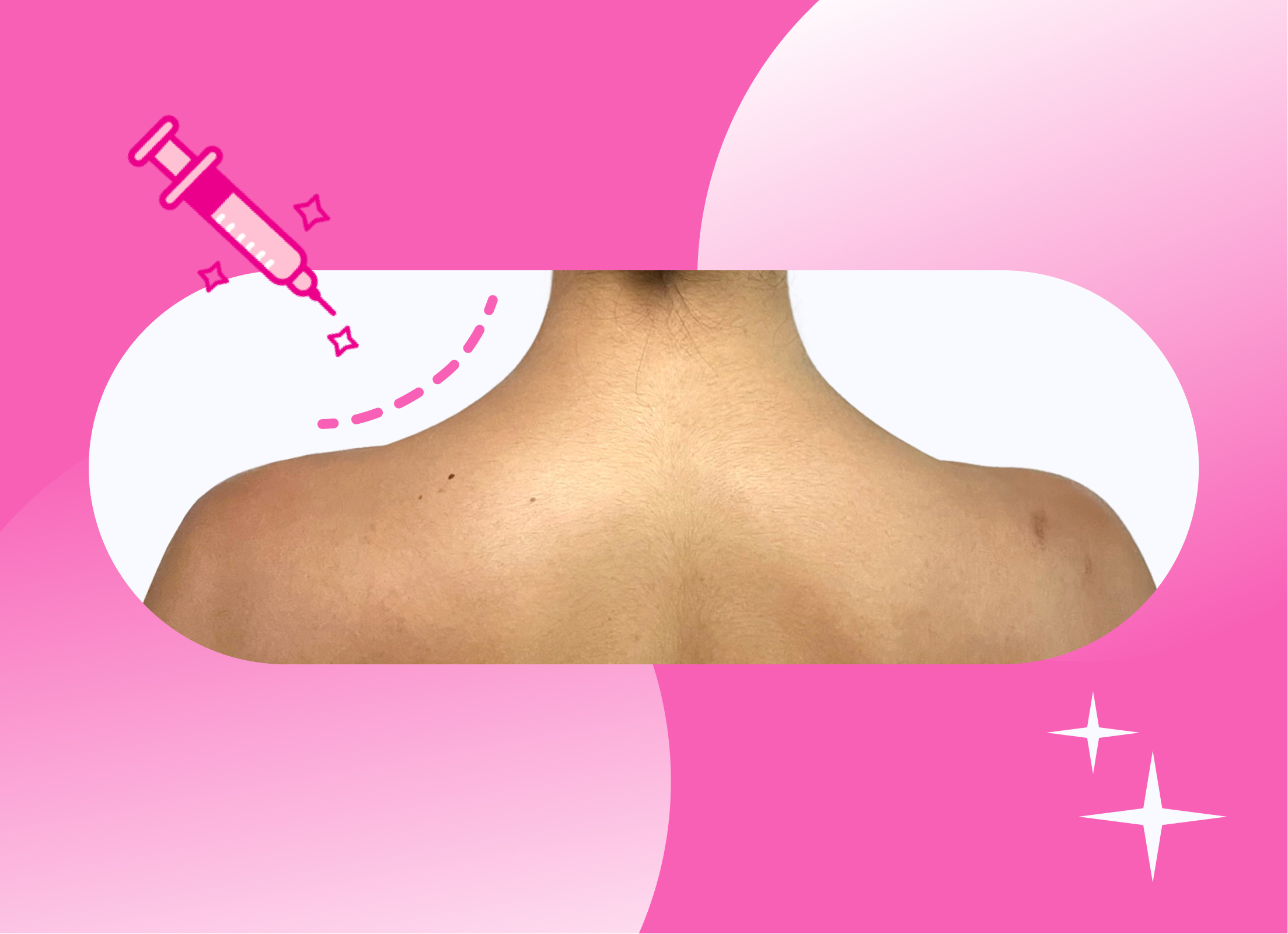 Upkeep | What is Barbie Botox?