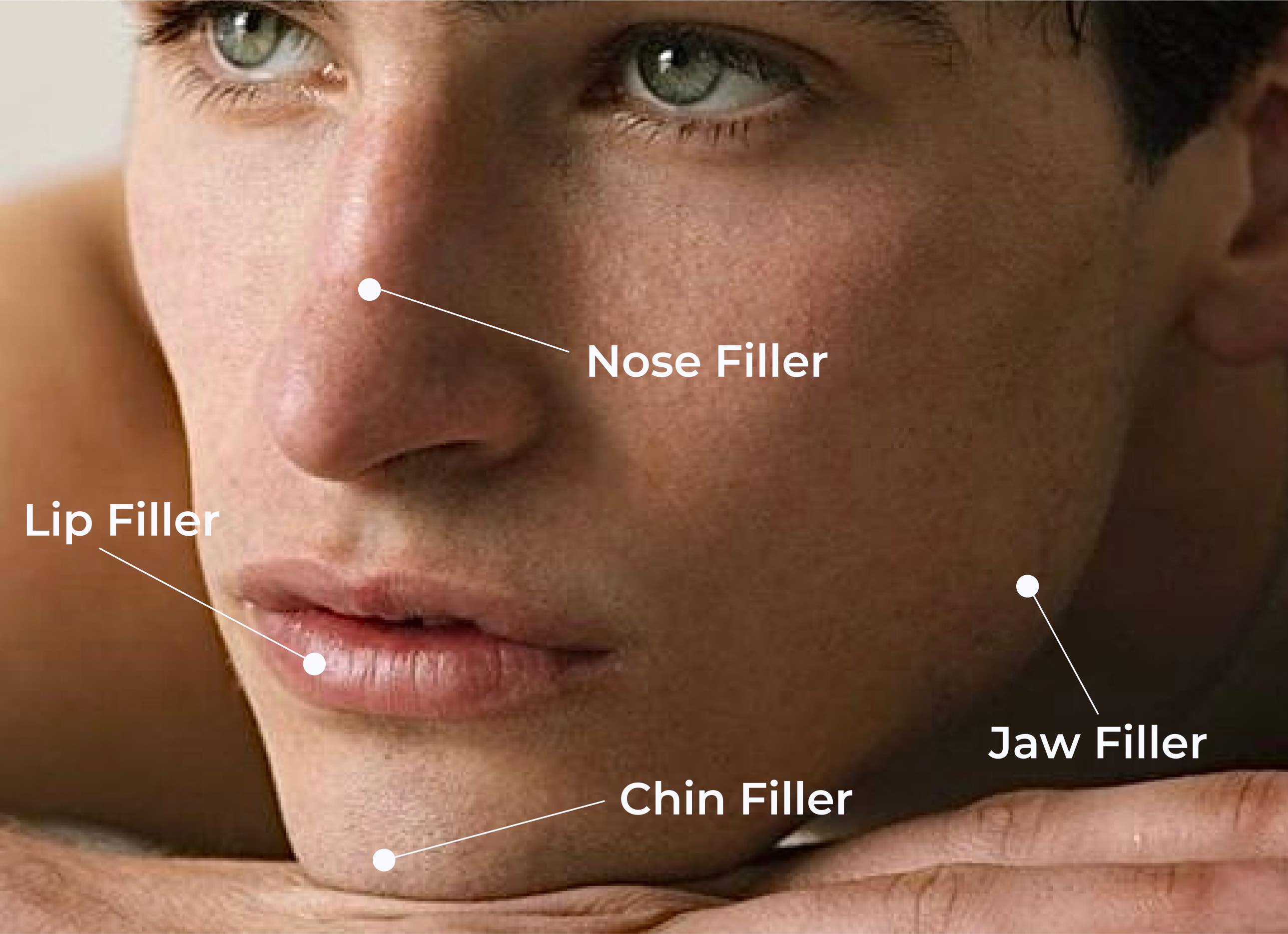 Upkeep | Every Man’s Guide to Dermal Fillers