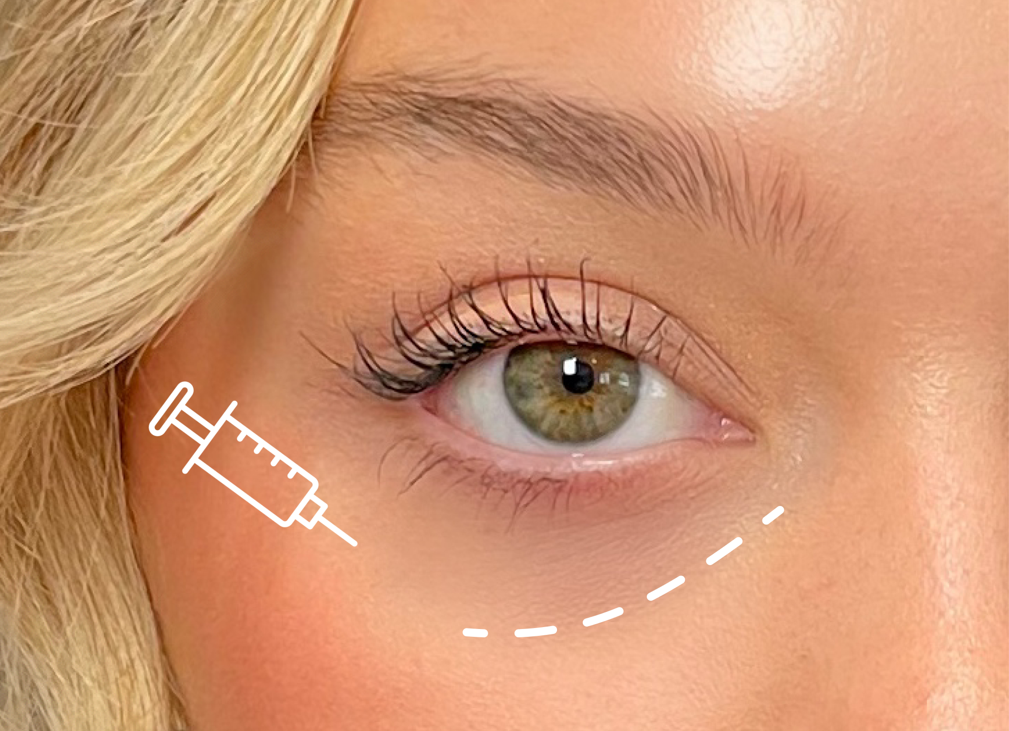 Upkeep | Upkeep’s Guide to PRF Injections