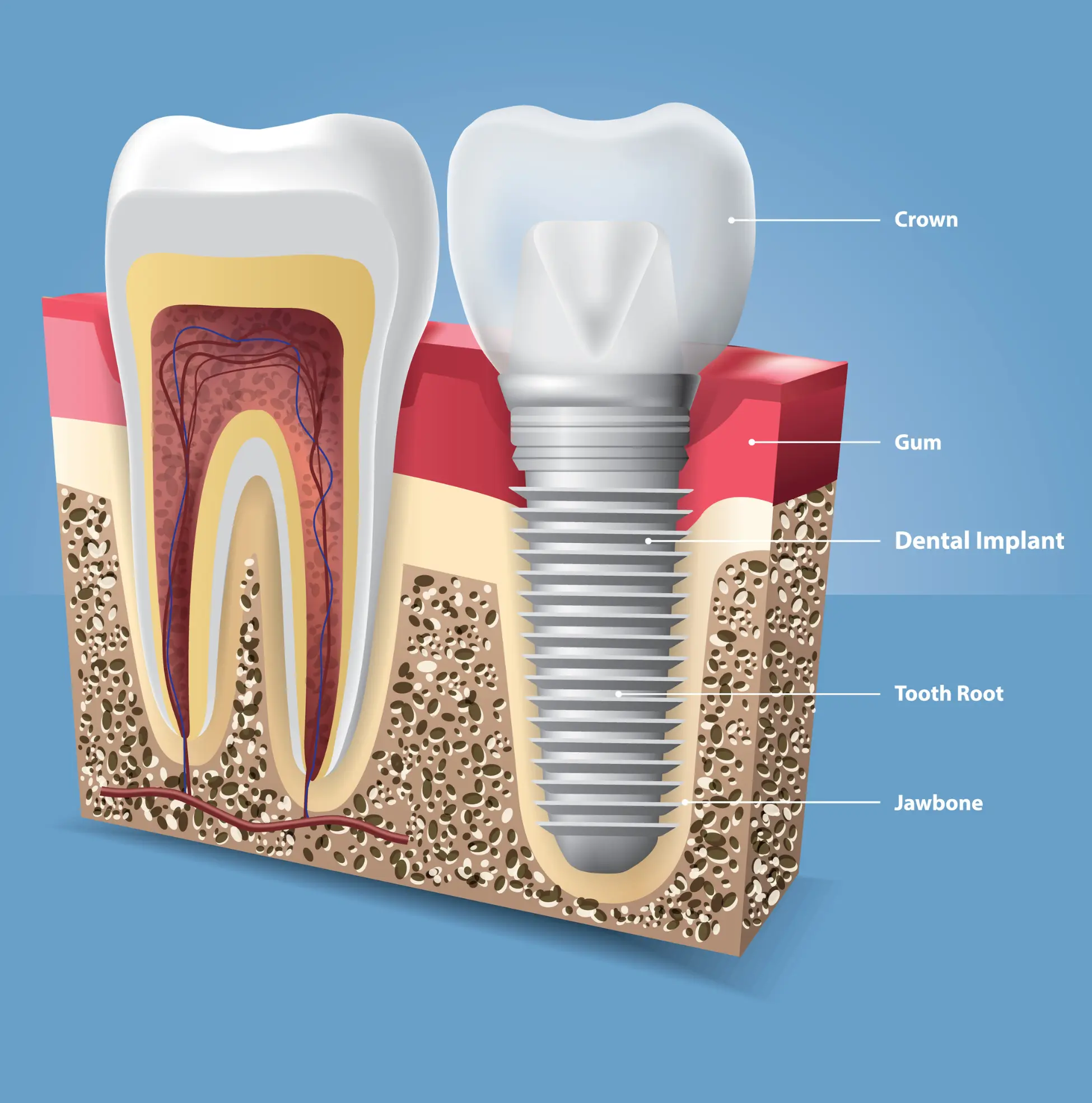 Dental Implants — a guide to this tooth replacement option