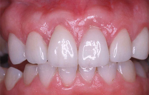 Smile Gallery | Mercer Island Dental