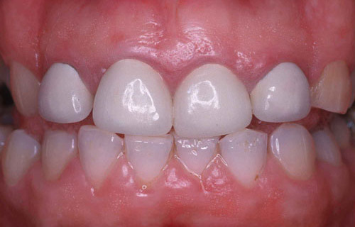 Smile Gallery | Mercer Island Dental