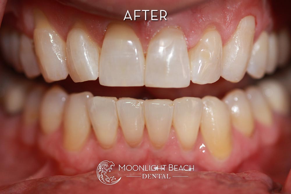 Before & After: Bonding & Invisalign | Moonlight Beach Dental