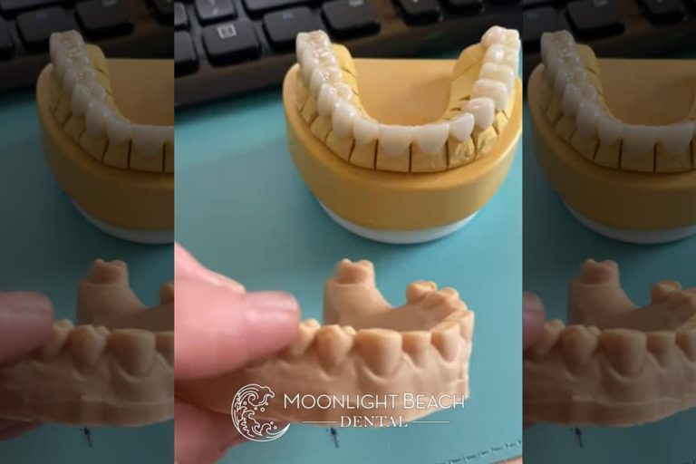 Before & After: Full Smile Transformation | Moonlight Beach Dental