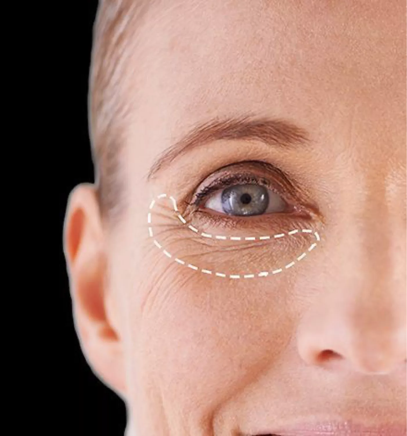 JECT Clinics | Fillers | Traangoot Skinbooster