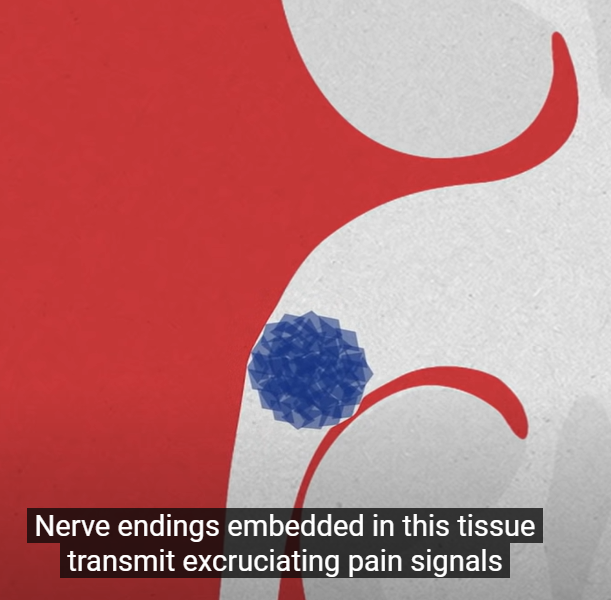 Kidney Stones Explained