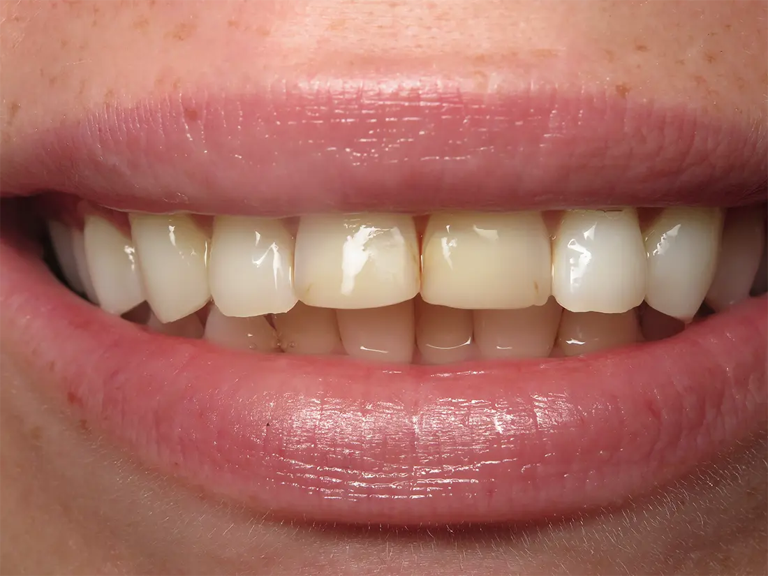 Before & Afters | Schultze Family Dentistry