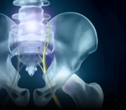 Lumbar Radiculopathy | Royal Spine Surgery