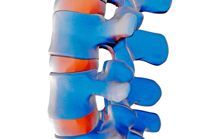 Lumbar Radiculopathy | Royal Spine Surgery