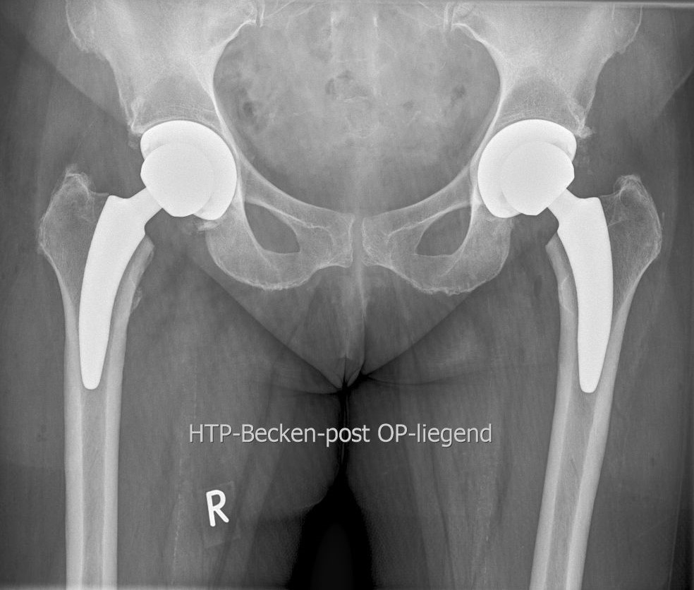 Beidseitige Hüft-TEP