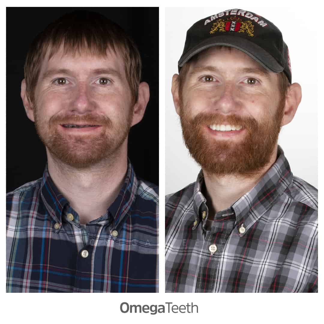Don't Want Dentures? Get Omega Teeth | Stanley Dentistry