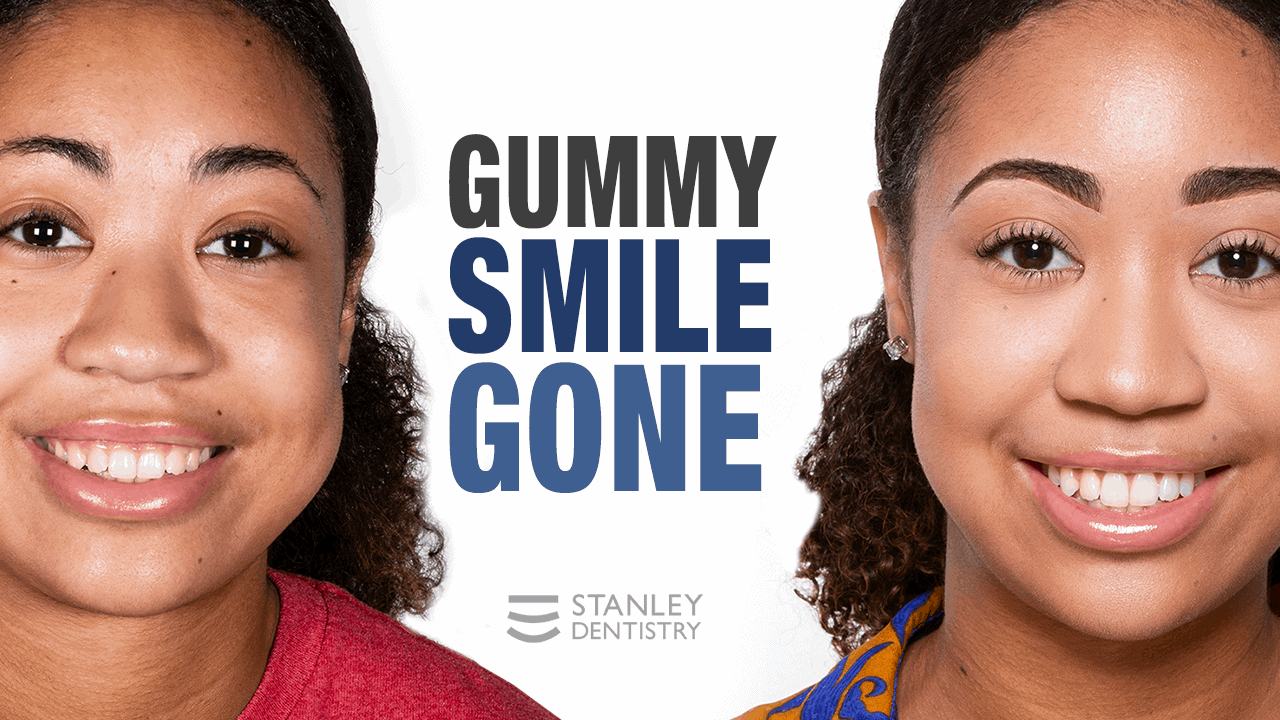 Gummy Smile Gone | Stanley Dentistry