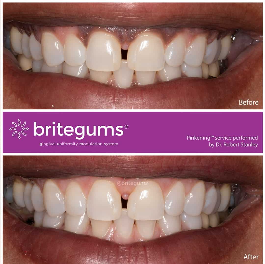 How to Cosmetically Fix "Peeling" Gums | Stanley Dentistry