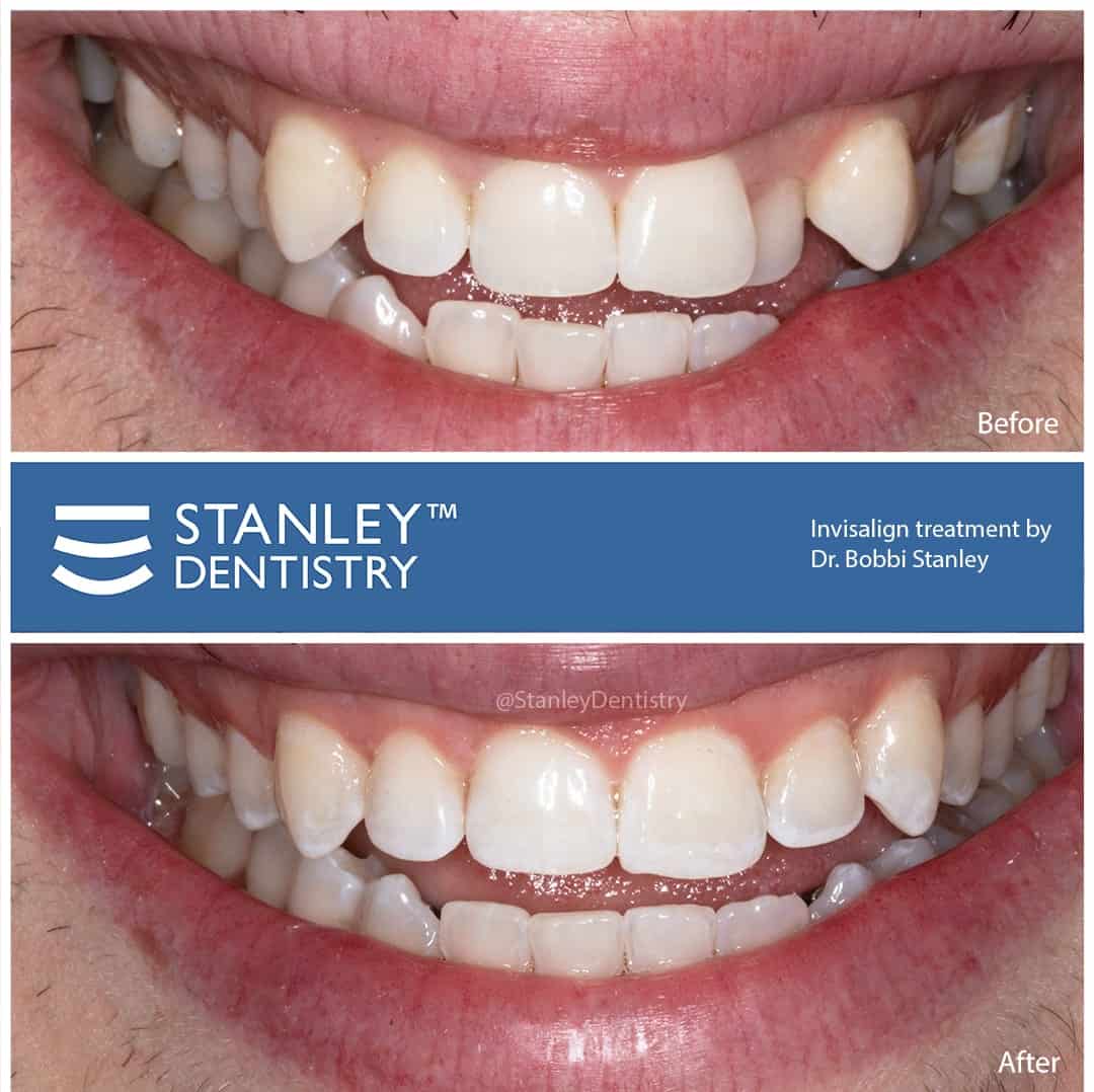 Invisalign Success Testimonial | Stanley Dentistry