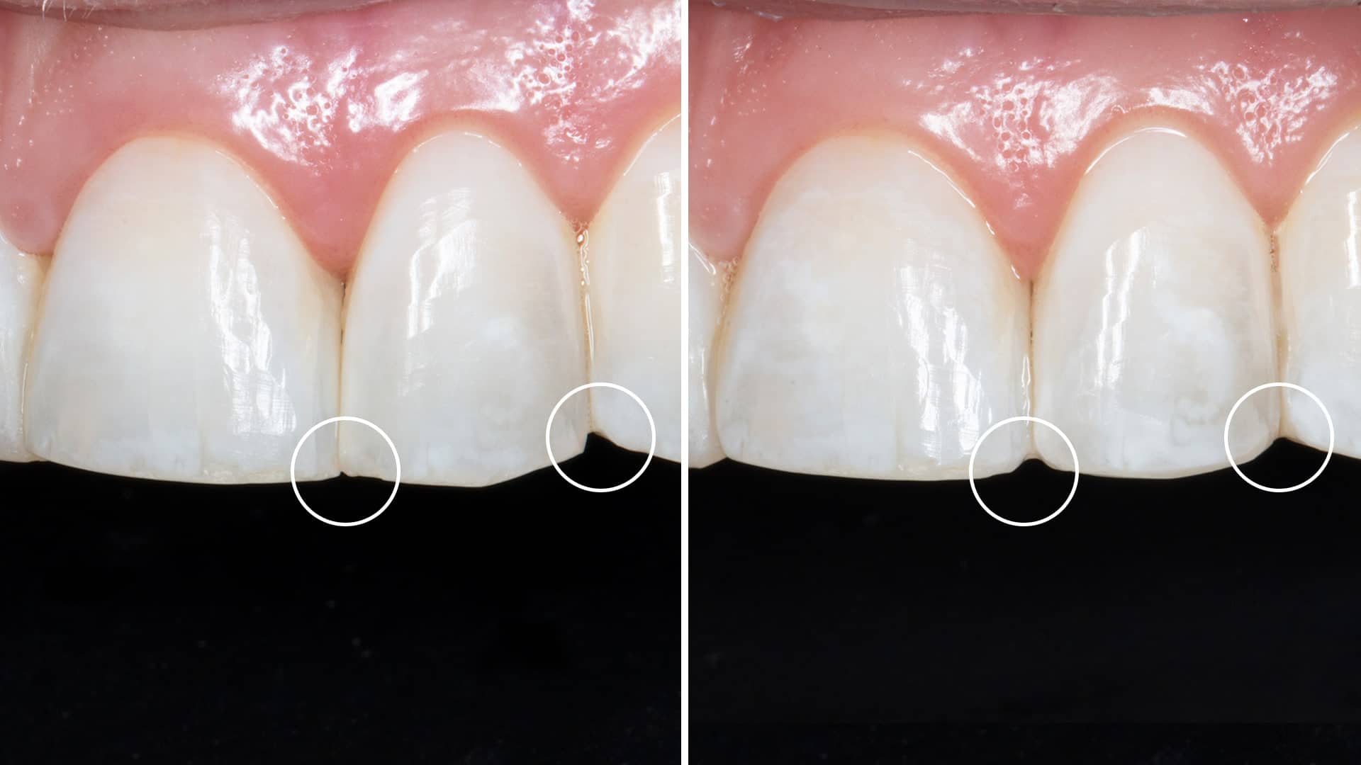 Do I Need an Enameloplasty? | Stanley Dentistry